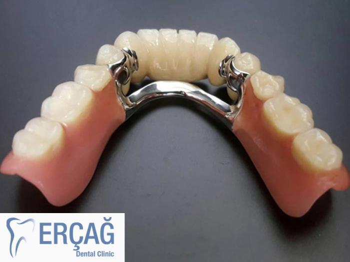 What is Crown Prosthesis? | Erçağ Dental Clinic
